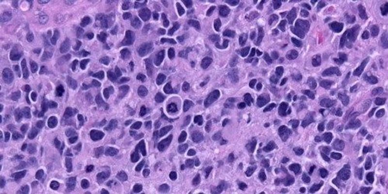 Pd L1 In Extracellular Vesicles May Help Glioblastoma Evade