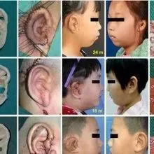 Children Receive Bespoke, Lab-Grown Ears | The Scientist