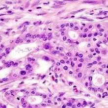 Pancreatic Cancer | The Scientist