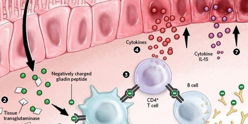 Infographic: Immune Irritation in the Gut | The Scientist