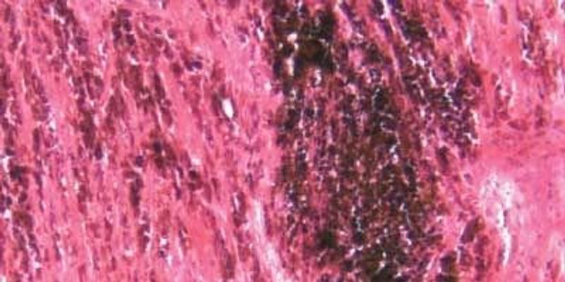 Rare T Cells Fight Cancer | The Scientist