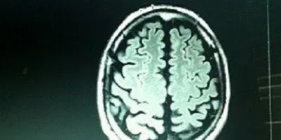 Infant Brain Scans May Predict Autism Diagnosis | The Scientist