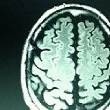 Infant Brain Scans May Predict Autism Diagnosis | The Scientist