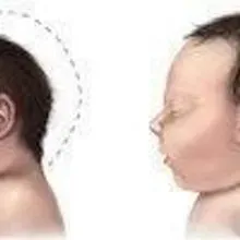 Microcephaly | The Scientist