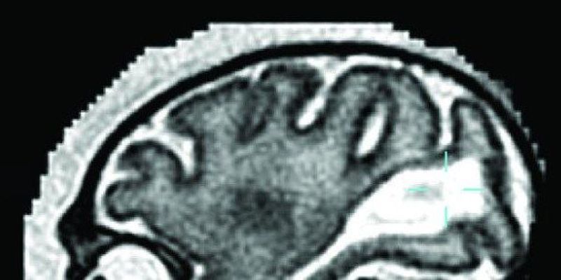 Zika-Associated Brain Injuries Found in Monkey Fetus | The Scientist
