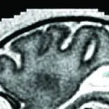 Zika-Associated Brain Injuries Found in Monkey Fetus | The Scientist