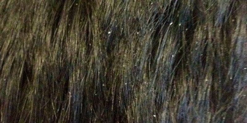 Scalp Microbiome Linked to Dandruff Severity | The Scientist