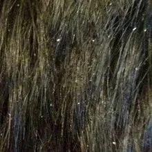 Scalp Microbiome Linked to Dandruff Severity | The Scientist