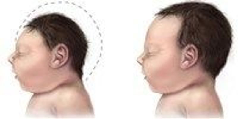 CDC: Zika Causes Microcephaly | The Scientist