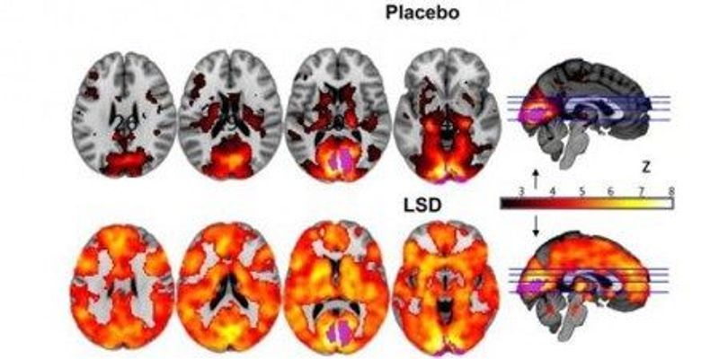 Psychedelic Neuroimaging | The Scientist