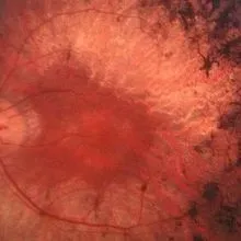 CRISPR Corrects Retinal Disease Mutation | The Scientist