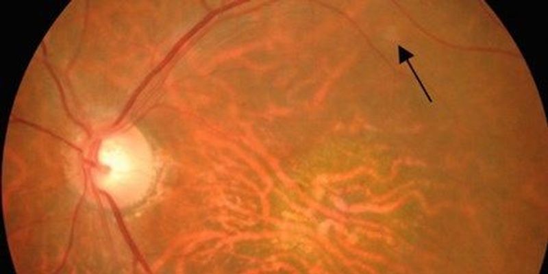 Eye Stem Cell Therapy Moves Ahead | The Scientist