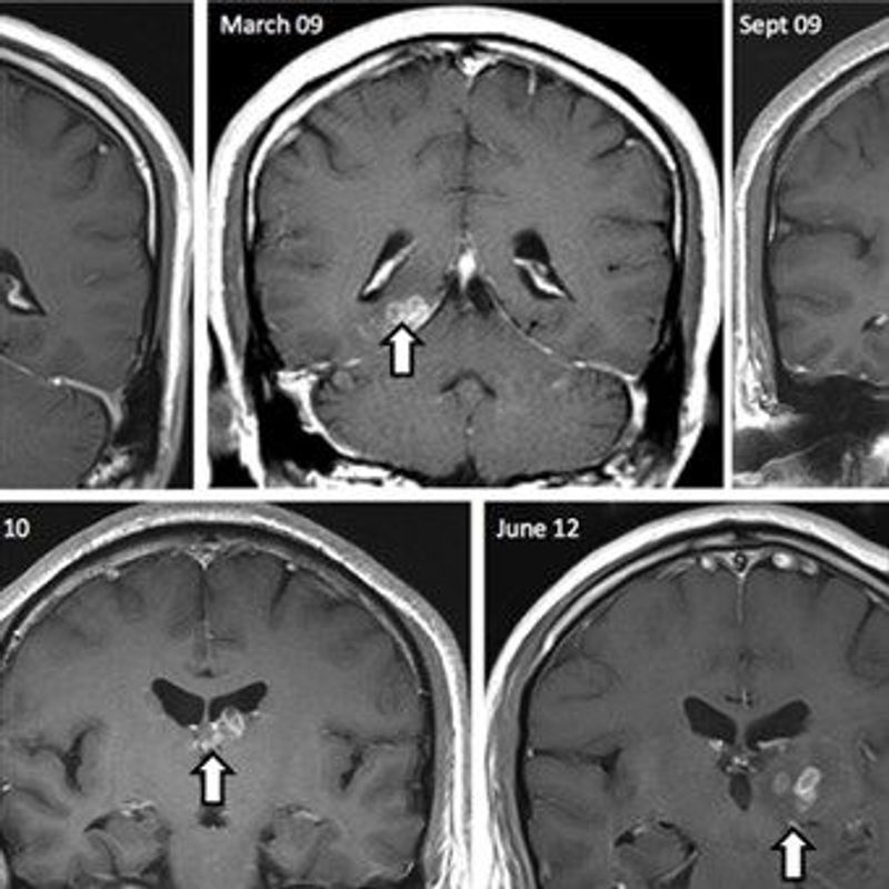 Tapeworm Inhabits Man’s Brain for Years | The Scientist