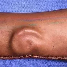 Army Surgeons Grow Ear in Soldier’s Arm | The Scientist
