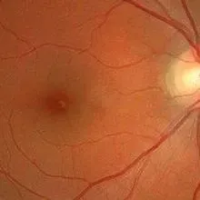 Stem Cell Trial for Eye Disease Commences | The Scientist