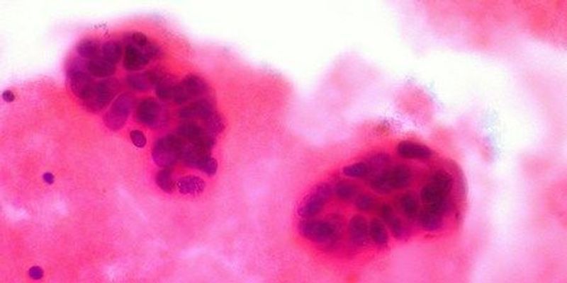 A Multi-Cancer Diagnostic? | The Scientist