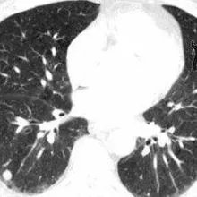 Gorillas in the Lung | The Scientist