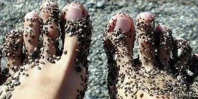 Foot Fungus Revealed | The Scientist