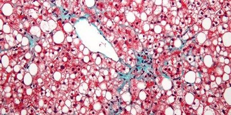 Obesity-Cancer Link Detailed | The Scientist