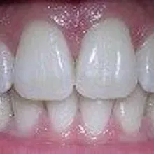 Teeth Out