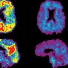 Neurofibrillary Tangles | The Scientist