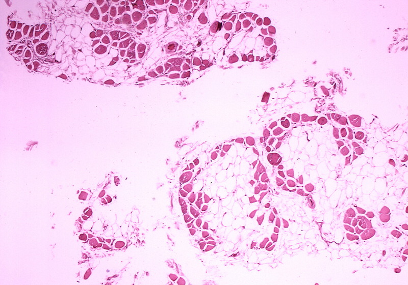 Positive Trial Results for Experimental DMD Gene Therapy | The Scientist