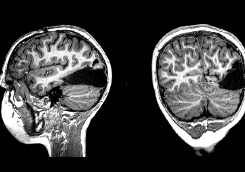 After a Lobectomy, a Boy Still Recognizes Words and Faces | The Scientist