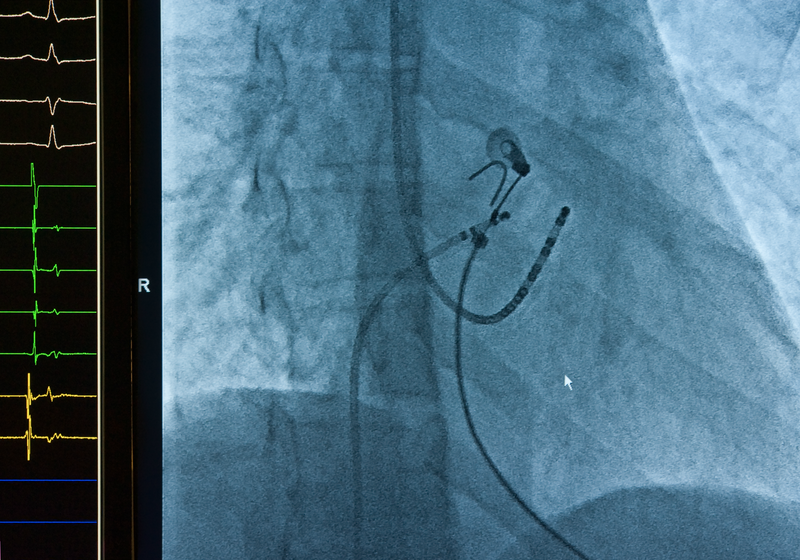A Common Atrial Fibrillation Procedure Is Aided by Damaging Neurons ...