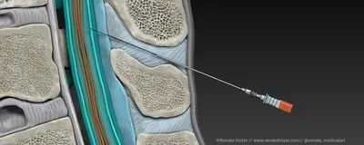Image of the Day: Spinal Tap | The Scientist