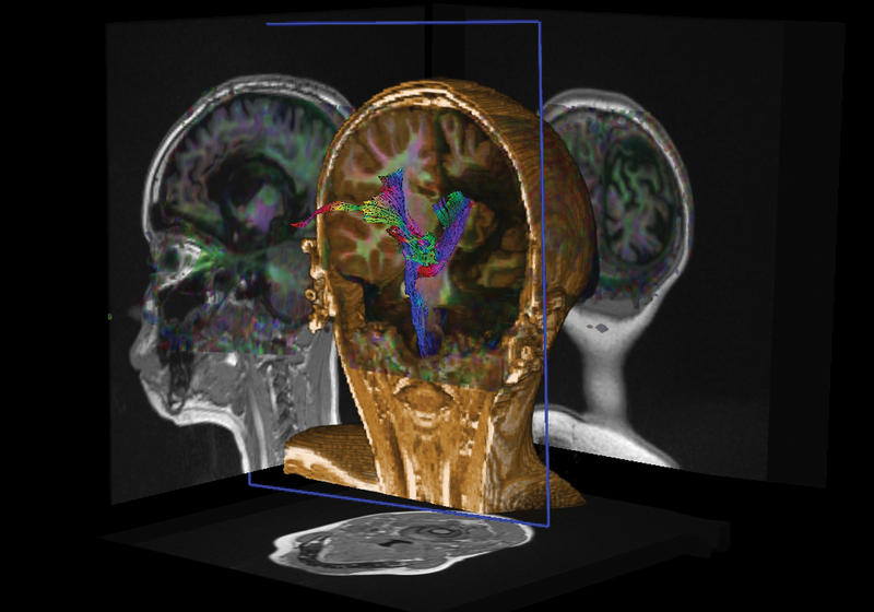 Paternal Age Linked to Brain Abnormalities Associated with Autism | The ...