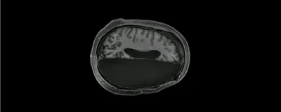 Missing Brain Hemisphere Tied to Fortified Neural Networks | The Scientist