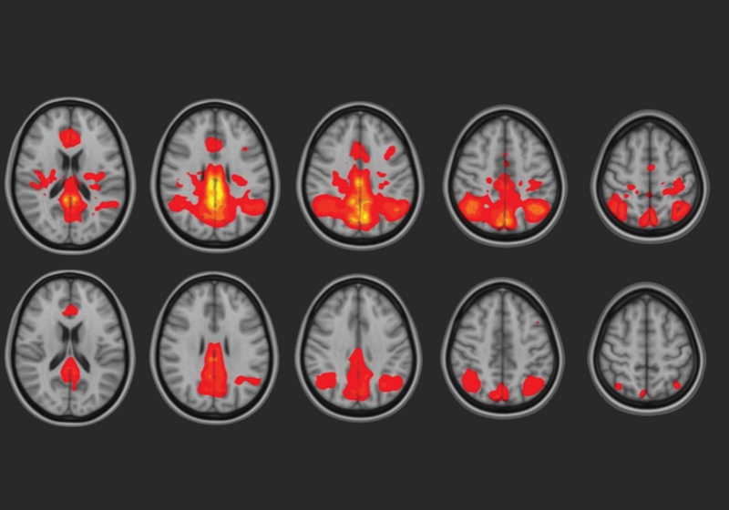 Non-Concussive Head Hits Influence the Brain’s Microstructure | The ...