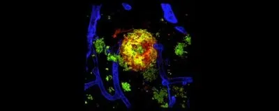 Newly Found Alzheimer’s Plaque Type Linked to Early-Onset Disease | The ...