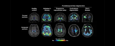 New Tracer Gives Clear Picture of Alzheimer’s and Other Dementias | The ...