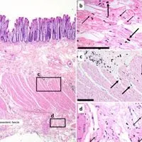 Cancer Cells Could Travel Through the Interstitium: Study | The Scientist