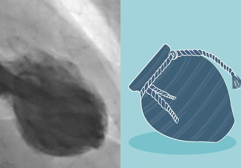 Broken Heart Syndrome Linked to the Brain | The Scientist