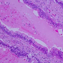 Pancreatic Cancer Tissue Pancreatic Cancer | The Scientist
