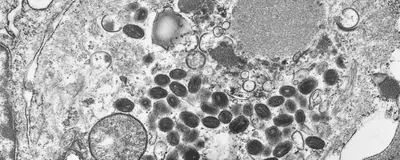 Opinion: Destroy All Samples of the Smallpox Virus | The Scientist