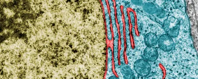 New Gene Mutants Identified in Rare Motor Neuron Diseases | The Scientist