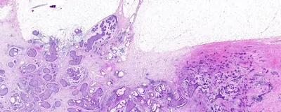 Harboring Hard and Soft Cells Lets Tumors Grow and Metastasize ...