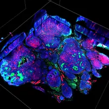 Pancreatic Cancer | The Scientist