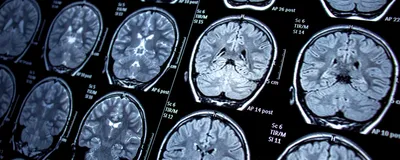 Blocking Scar Formation Prevents Glioblastoma Recurrence | The Scientist