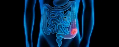 Colorectal Tumors are Born When Stem Cells Die | The Scientist
