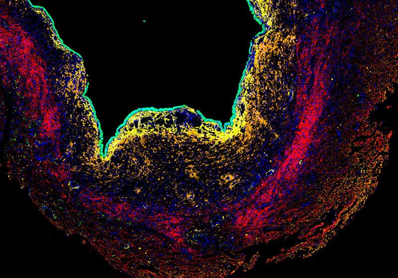 Understanding the Cellular Landscape that Fuels Endometriosis | The ...