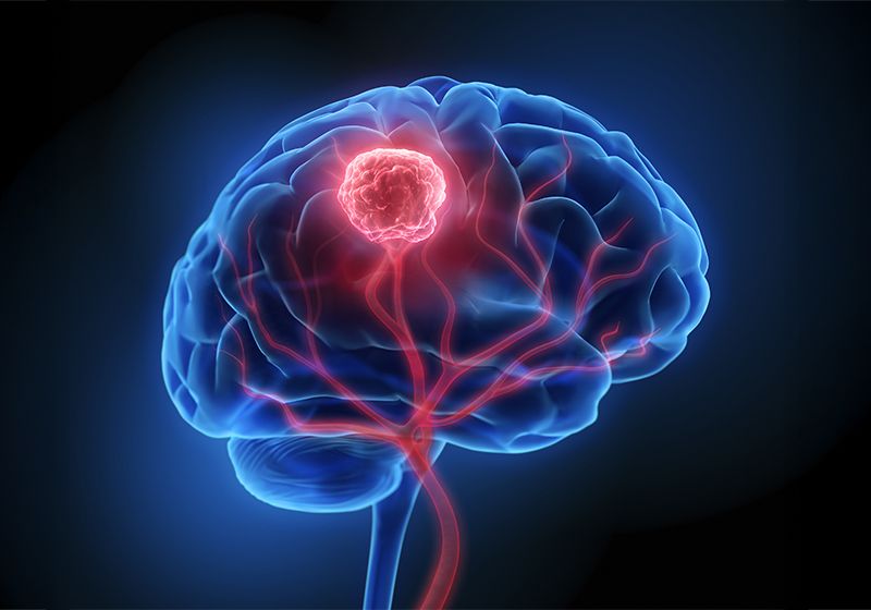 Repurposed Cancer Drug Could Help Treat Brain Tumors | The Scientist