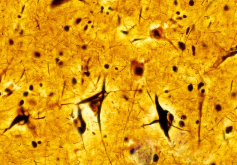 Tau Protein Function and Disease Roles | The Scientist