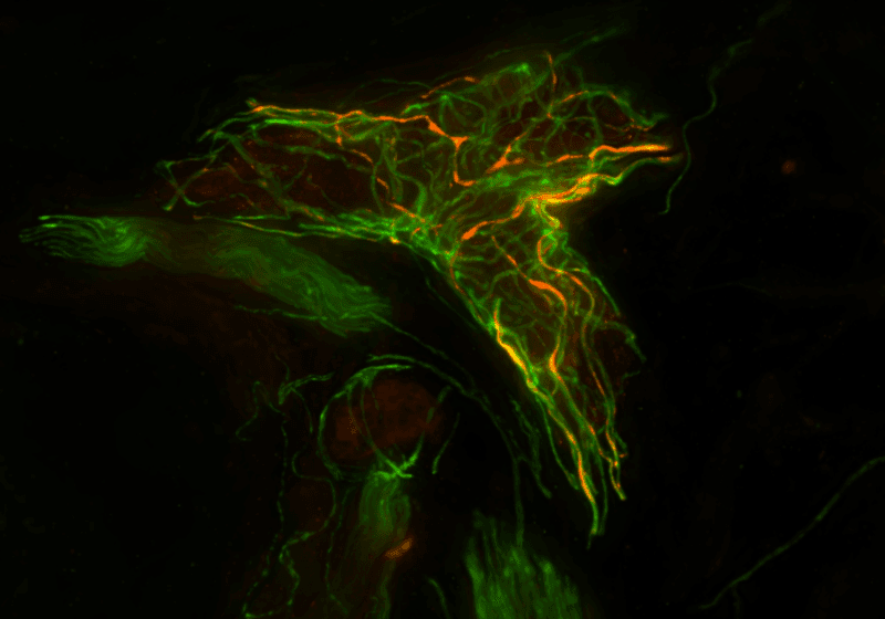 Diagnosing Synucleinopathies with Skin Biopsies | The Scientist
