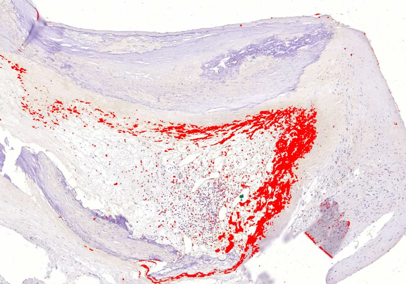 Biofilm Bacteria Shielded in Plaques May Trigger Heart Attacks | The ...