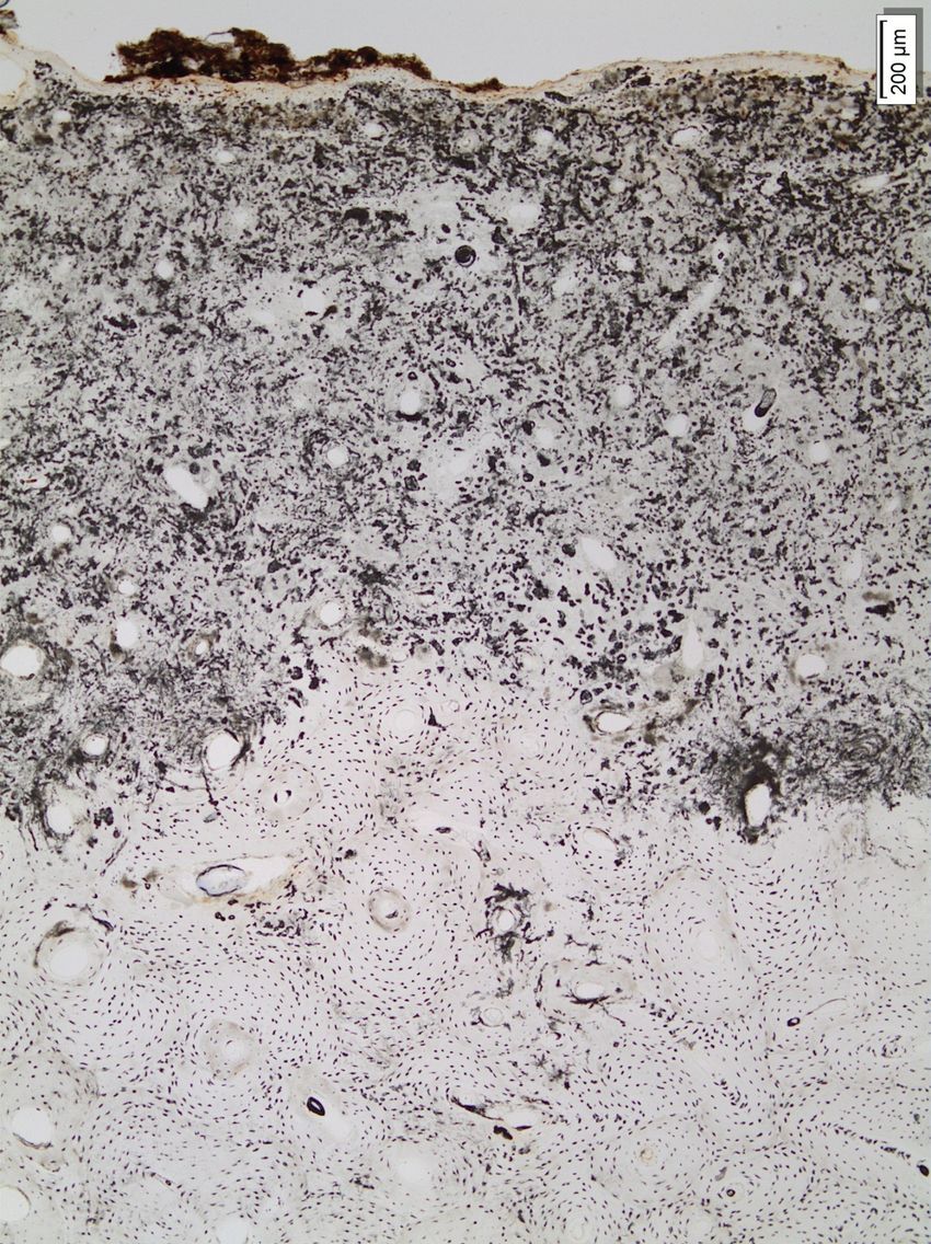 Centuries-Old Skeletons Reveal the Microbes That Consume Bone | The ...