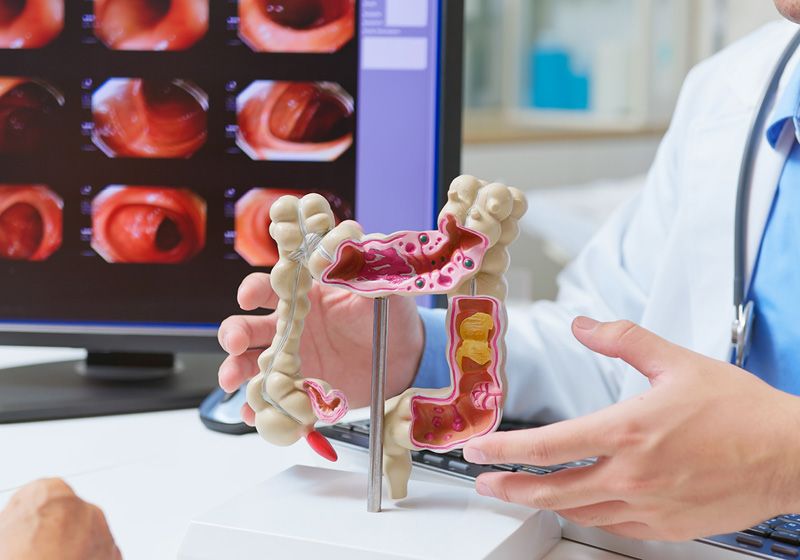 American Cancer Society Updates Colorectal Cancer Screening Guidelines ...
